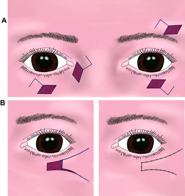 Flap Reconstruction - sunsmileclinic.com.au
